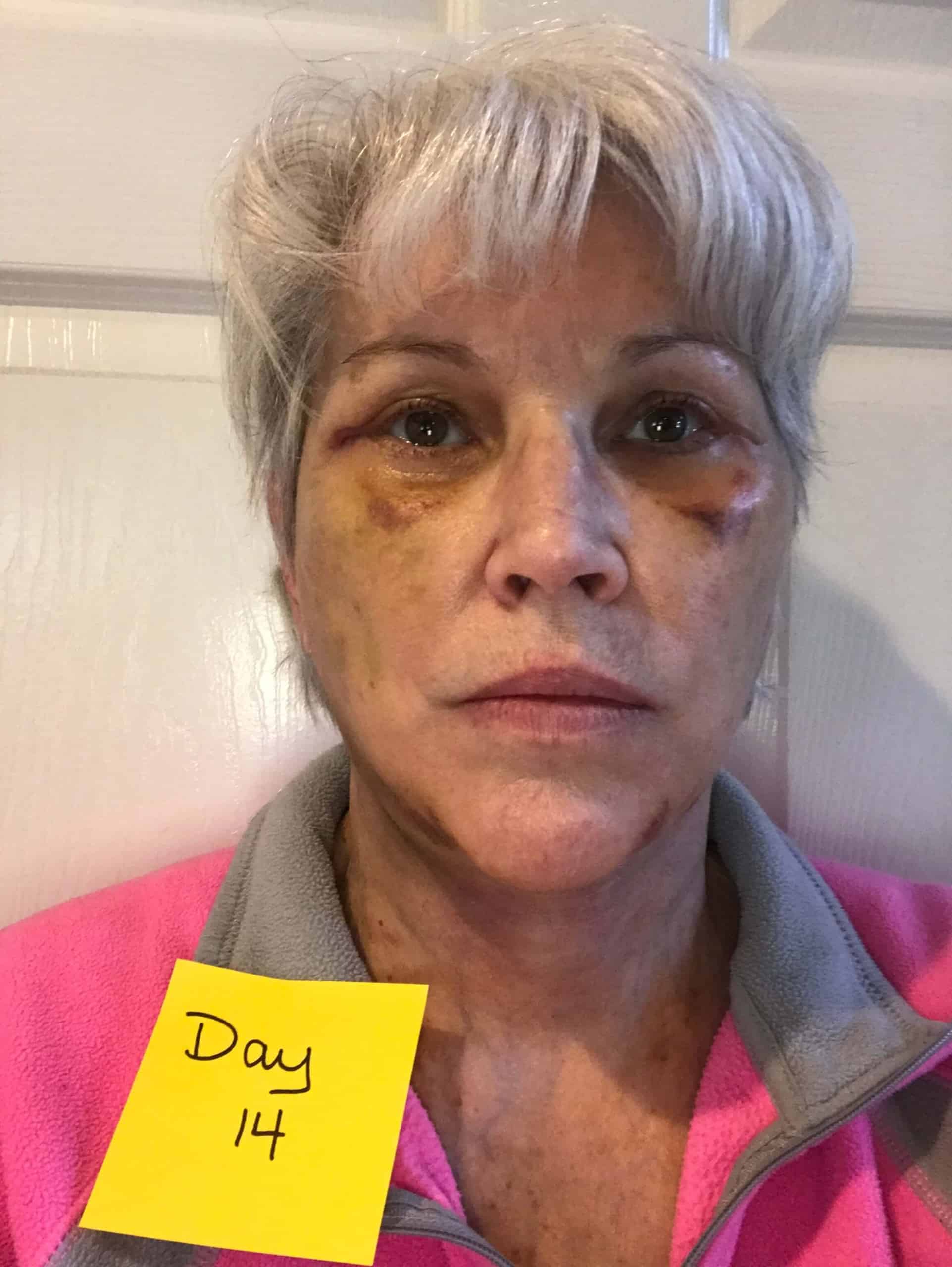 Recovering from Cosmetic Surgery: Erin’s Facelift Journey Part 3 - I ...